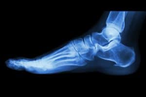 Foot Injury At Work Compensation Claims - Personal Injury Claims Care